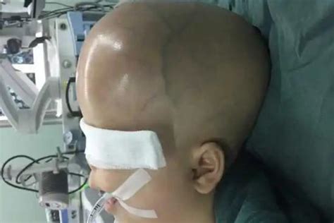 脑积水的头型图有来医生