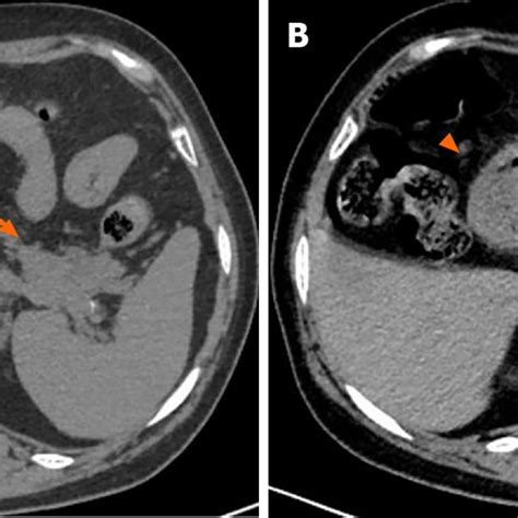 Upper Abdominal Computed Tomography Images A A Lobulated Solid Mass Download Scientific