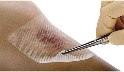 Antimicrobial Dressing Medloc