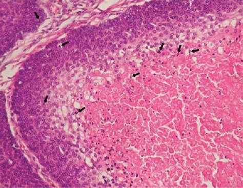 Histopathologic Findings Biopsy Shows Hyperchromatic Basaloid Cells Download Scientific