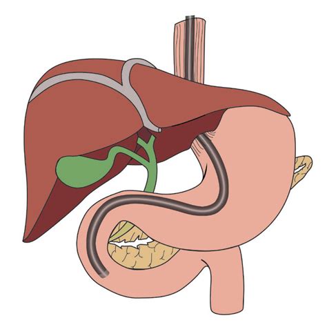 Endoscopy And Ercp At Erin Mackenzie Blog