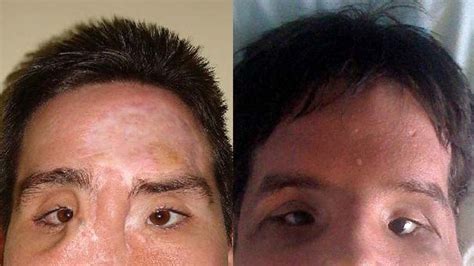 Transplant Patient Reveals New Face Abc Listen