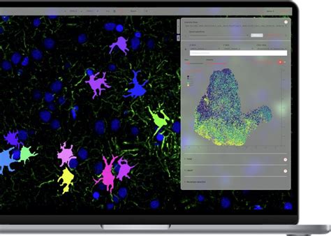 Aacr2025 Glioblastoma Brain Tumor Cancer Oncology Dr Lucas Schütz