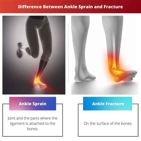 Ankle Sprain Vs Fracture Difference And Comparison