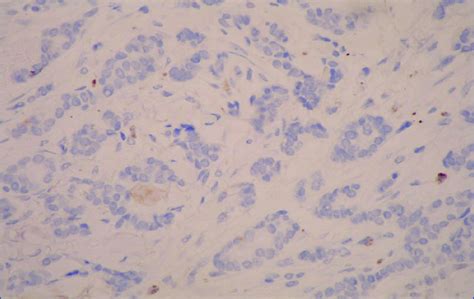 Immunohistochemical Detail Of The Primary Scalp Tumor Showing A Download Scientific Diagram
