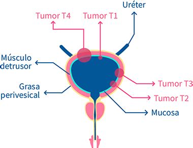 Clasificación Del Cáncer De Vejiga
