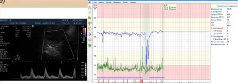 Pulsatility Index In Uterine Arteries Download Scientific Diagram