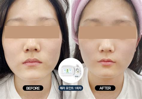 피부관리 숍에서 하이푸hifu 리프팅을 찾는 이유 네이버 블로그