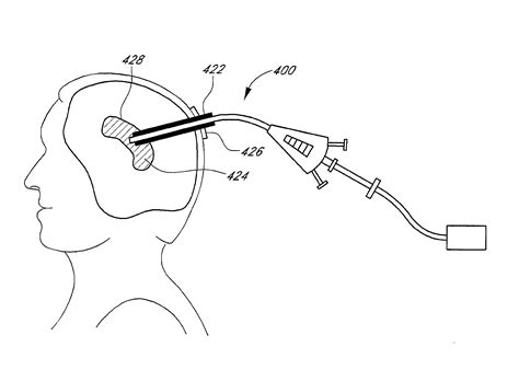 Intracerebral Hemorrhage Patented Technology Retrieval Search Results