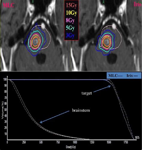 Axial Dose Distributions Top And Dose Volume Histogram Bottom Of