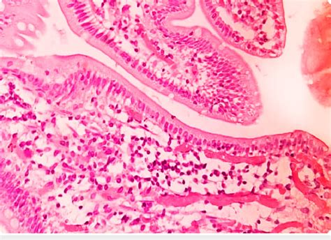 A Biopsy From The Terminal Ileum Reveals Small Intestinal Mucosa With Download Scientific
