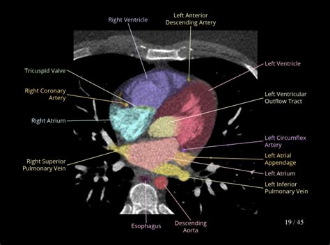 Heart Ct Scan Labeled