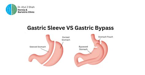 Gastric Bypass Vs Gastric Sleeve Guide By Dr Atul Shah