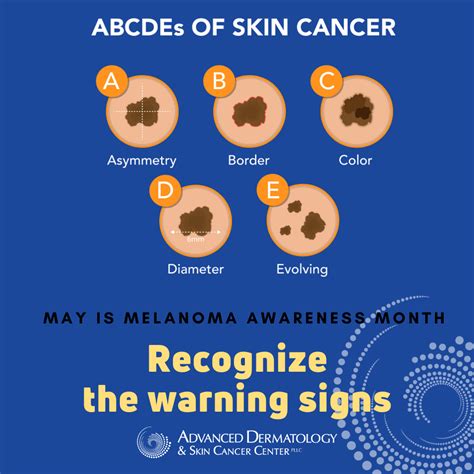 Early Stage Melanoma Pictures