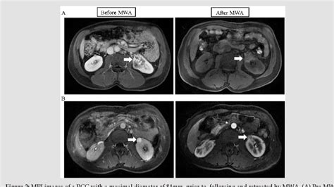 Figure 2 From Ultrasound Guided Percutaneous Microwave Ablation Of Bilateral Renal Cell