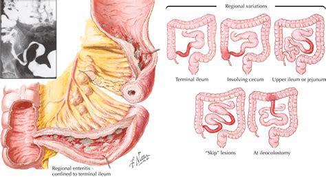 Crohn Disease Clinical Tree