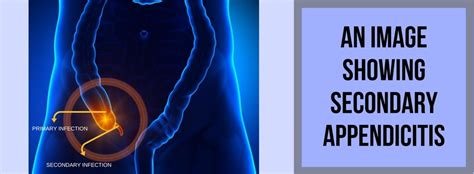 Appendix Removal Surgery In Chennai Dr Maran Gastro Surgeon