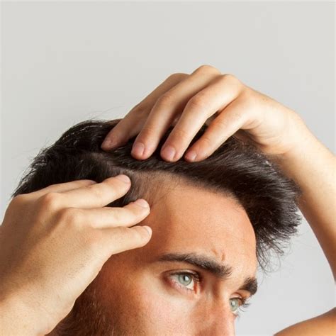 Dry Scalp Causes And How To Treat Them