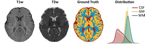 Data Of A 6 Month Old Infant From The Training Set In Iseg 2019 The Download Scientific