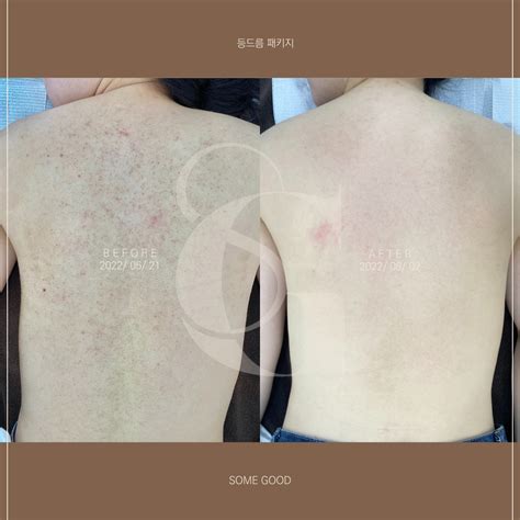 등드름•가드름•팔뚝 모공각화증•여드름흉터를 전문으로 관리하는 곳은 썸굿이 유일합니다 부산광역시 부산진구 범천동 피부관리 당근 비즈 소식