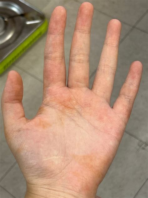 팔과 손에 갈색반점이 생겼어요 지식in