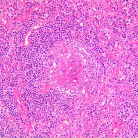 Glomeruloid Hemangioma On The Right Thigh Download Scientific Diagram