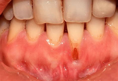 Initial View Class Iii Gingival Recession Download Scientific Diagram