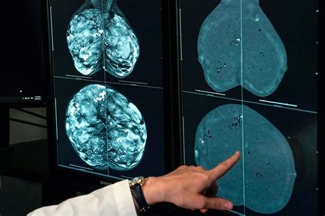Why Dense Breast Tissue Matters Shero Imaging Commentary On Nyt