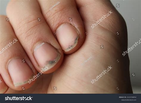 1932 Imágenes De Damaged Fingernails Imágenes Fotos Y Vectores De