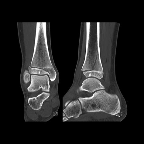Salter Harris Fracture Pediatric Radiology Reference Article