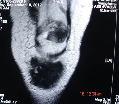 Msk Pre Patellar And Pre Tibia Cellulitis And Bursitis 5 Radioogle