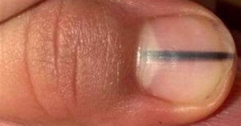 What Does A Brown Line On Your Fingernail Mean Design Talk