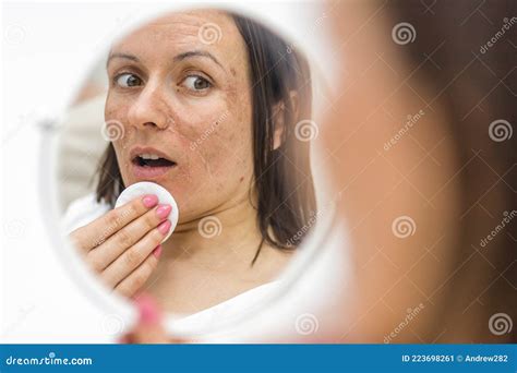 Skin Problems Angulitis Angular Stomatitis Angular Cheilitis A Disease Of The Mucous Membrane