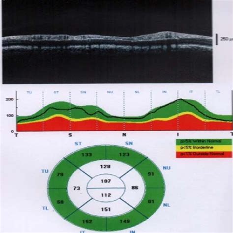Normal Rnfl Thickness In The Right Eye Of A Patient Without Vitamin D