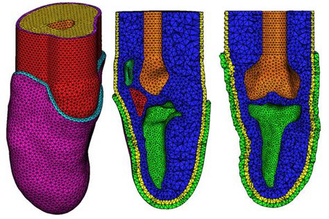 typical solid tetrahedral mesh of the residuum liner and socket