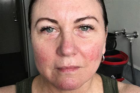 Pelvic Mesh Implants Class Action One Woman S Story Of Mesh Injury