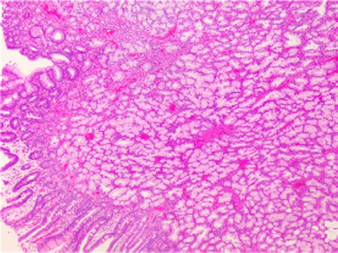 Gastrointestinal Bleeding By Brunners Gland Hamartoma Overhanging In The Descending Duodenum