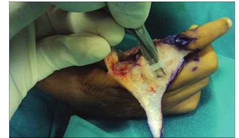 Extensor Digitorum Communis And Extensor Indicis Proprious