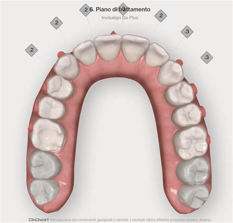 Ipr Management In Clear Aligners Therapy Garrison Dental