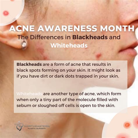 What S The Difference Between Blackheads And Whiteheads In Types Of Acne Facial
