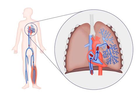Procedimientos Innovadores Para El Tromboembolismo Pulmonar Voz Libre