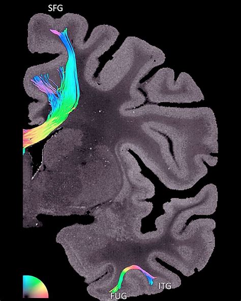 Dti Tractography Mri Radiology Mri Neuroscience Vahid Shahmaei