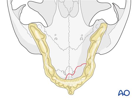 Rostral Intraoral Splint Fixation For Midface Panfacial Fracture