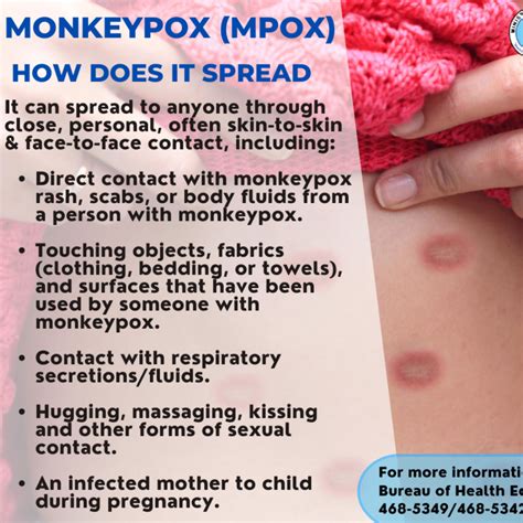 Ministry Of Health Enhances Mpox Precautionary Measures And Isolation Protocols Government Of Ministry Of Health Enhances Mpox Precautionary Measures And Isolation Protocols Government Of