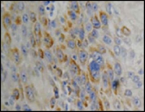 High Bax Cytoplasmic And Nuclear Membrane Staining In Low Grade Download Scientific Diagram