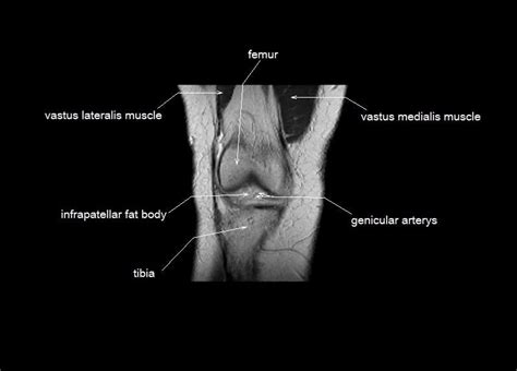 Mri Anatomy Of Knee Joint Pin By Fateme On Knee Mri Anatomy Of The