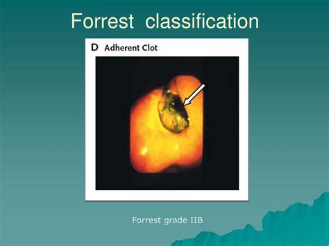 Ppt Management Of Acute Bleeding From A Peptic Ulcer Powerpoint