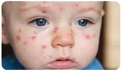 Варицела при деца Шарка БГ Всичко за Шарка Варицела