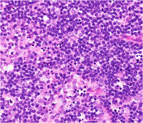 Kikuchifujimoto Disease Manifesting Bilateral Lymphadenopathy