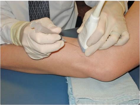 Proximal Tibiofibular Joint Injection Wikism Sports Medicine Wiki